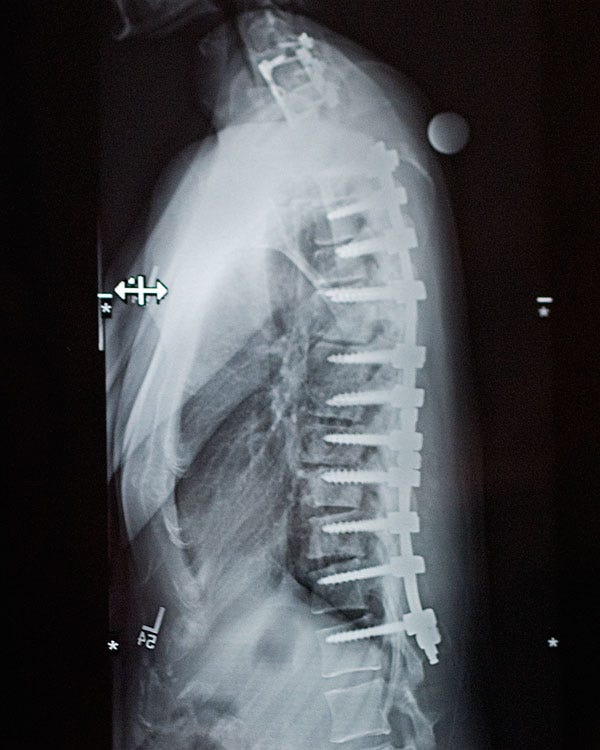Interview #10: Scott and Sarah Pruett (Three Spinal Cord Injuries - C6 ...