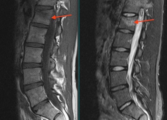 Inside the consult room: 19 year old with a spinal compression fracture