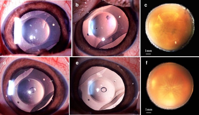 Visian ICL: experience with Visian ICL and Visian ICL surgery EVO
