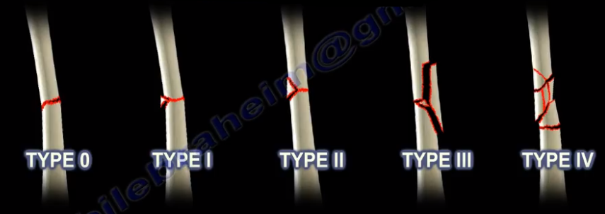 Fractures of the Shaft of the Femur- Winquist & Hansen Classification