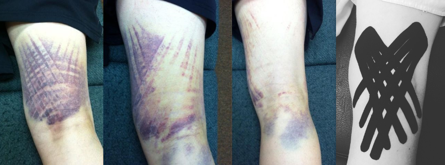 Kinesio / Rock Tape – Dr. Jessie Hsieh D.C. – Medium