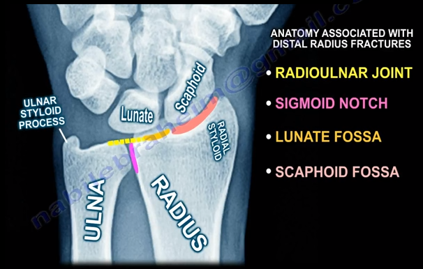 Common Types of Distal Radius Fractures – Nabil Ebraheim – Medium
