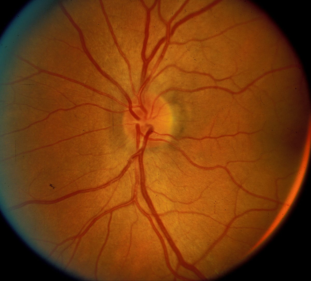 An International Treatment Trial for Patients with NAION