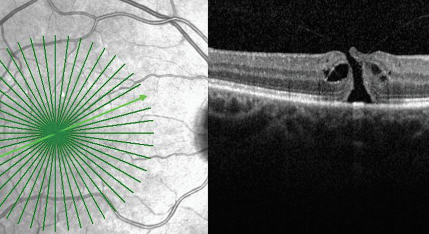 Vitreomacular traction and full thickness macular hole