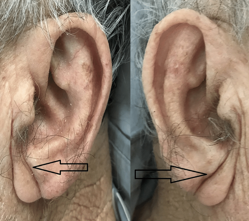 GOT EAR CREASES? YOU MAY BE A WALKING TIME BOMB – Ketto Blog – Medium