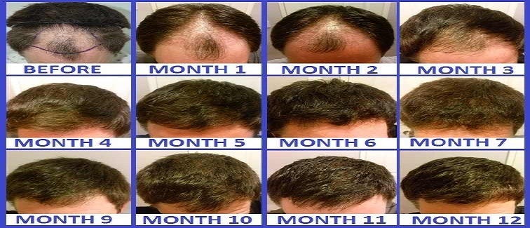 How To Check Hair Transplant Result Before Going For Hair Transplant