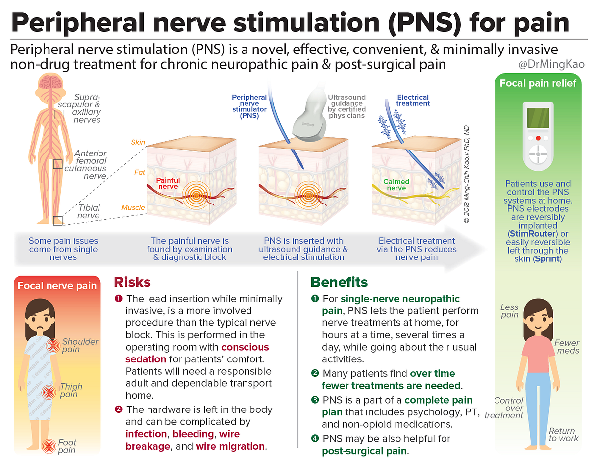 Peripheral nerve stimulation (PNS) for chronic pain & post-surgical pain