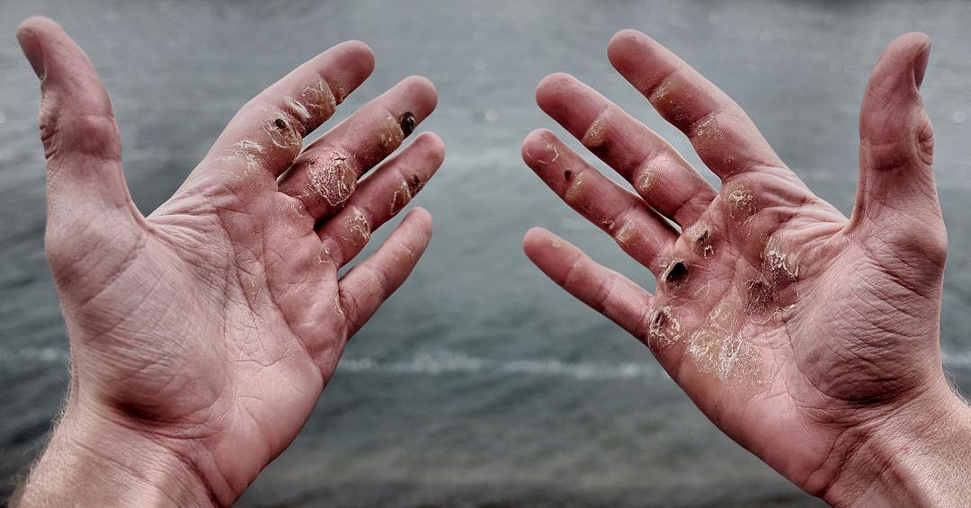 Rowing Blisters 101 – Kayleigh D. – Medium