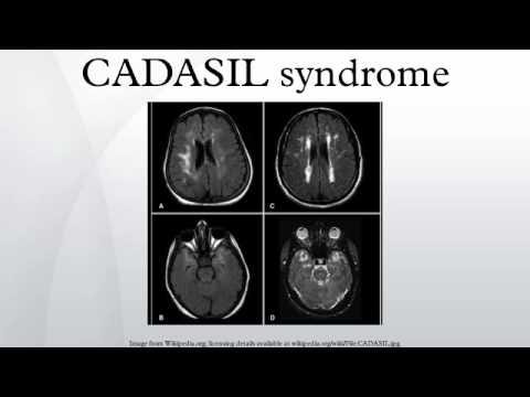 What is CADASIL and how is it different than other dementia?