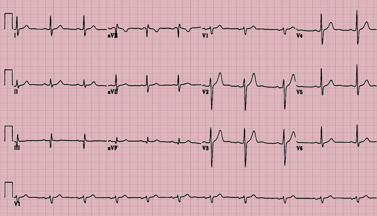 “Know Your Resources” Series: Best EKG Resources – Residency Hacker ...