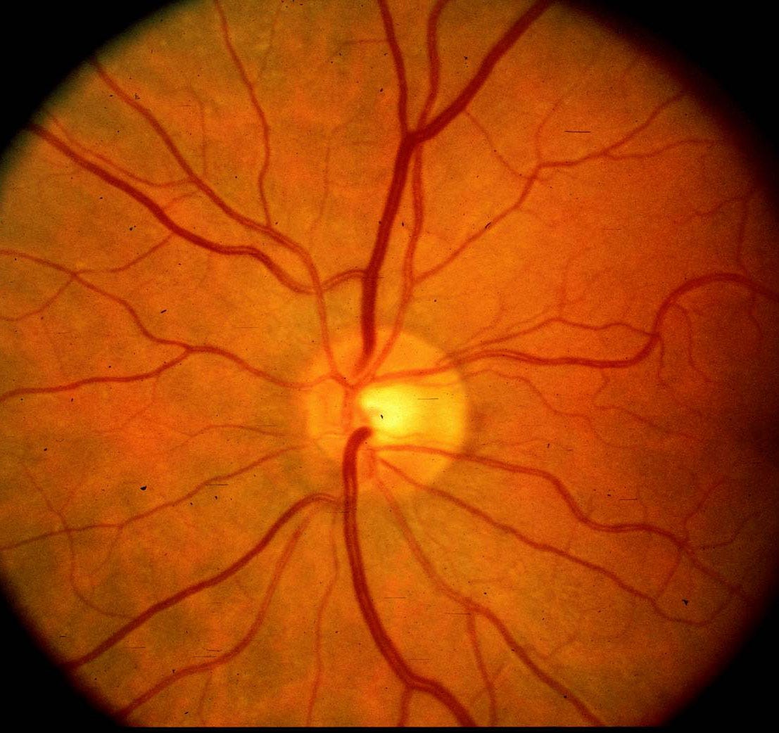 An International Treatment Trial for Patients with NAION