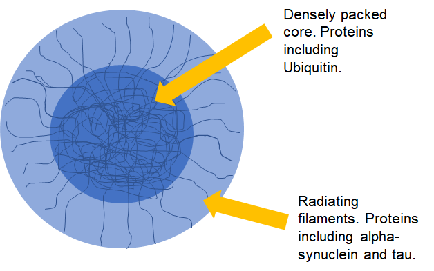 Lewy bodies: the story so far – PARKINSON’S UK – Medium