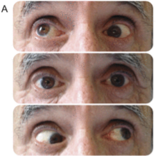 Neuro-ophthalmology Question of the Week: Abnormal Lateral Gaze