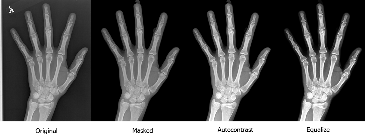 Neuromation Research: Pediatric Bone Age Assessment with Convolutional ...