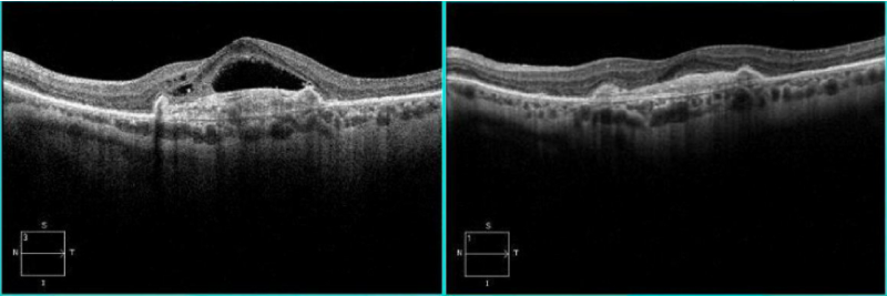 Machine Learning and OCT Images — the Future of Ophthalmology