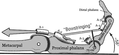 A2 Pulley Injuries in Rock Climbing – Dr. James Lee PT, DPT, FAAOMPT ...