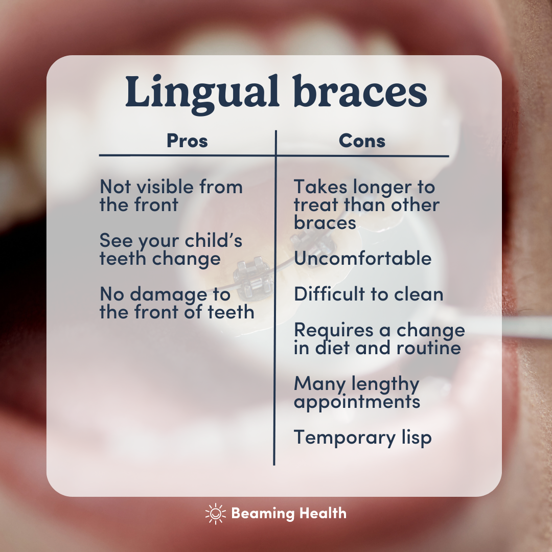 Lingual Braces Pros And Cons