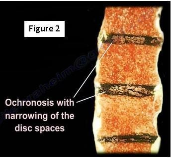 Ochronosis, Black Urine – Thrive Global – Medium