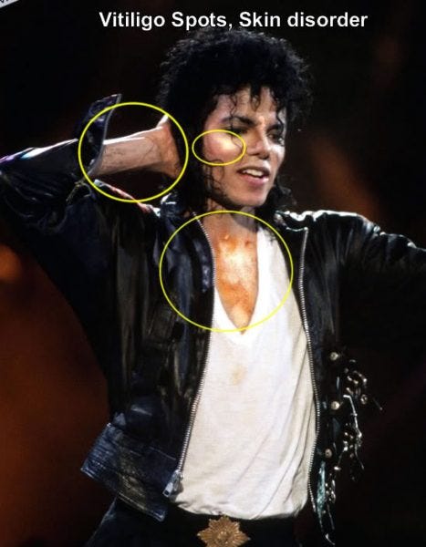How I cured Vitiligo (Michael Jackson had it too). – Angela Shurina ...