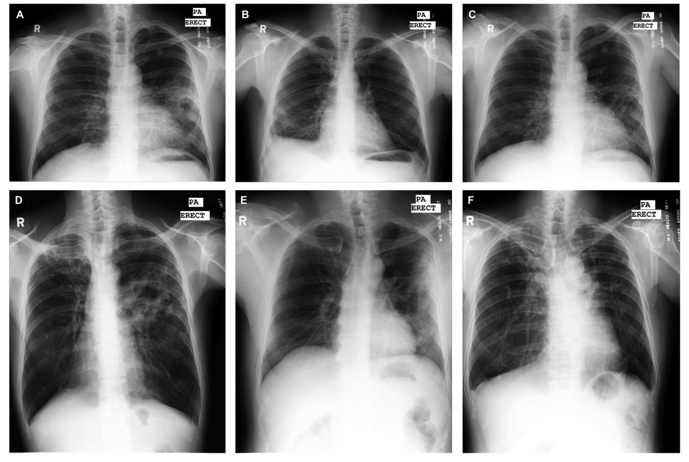It S Chest Day Uses Of Deep Learning In Chest Abnormality Detection