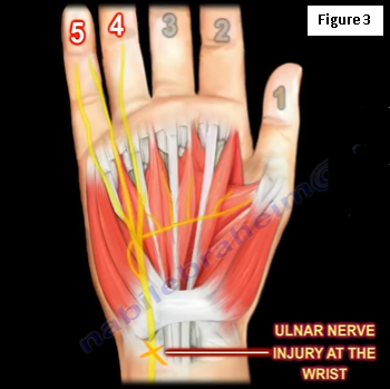 Ulnar Claw Hand – Thrive Global – Medium