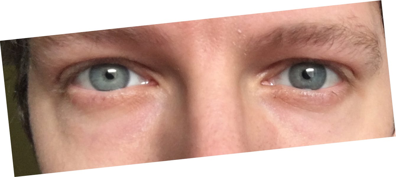 Visian ICL: experience with Visian ICL and Visian ICL surgery EVO