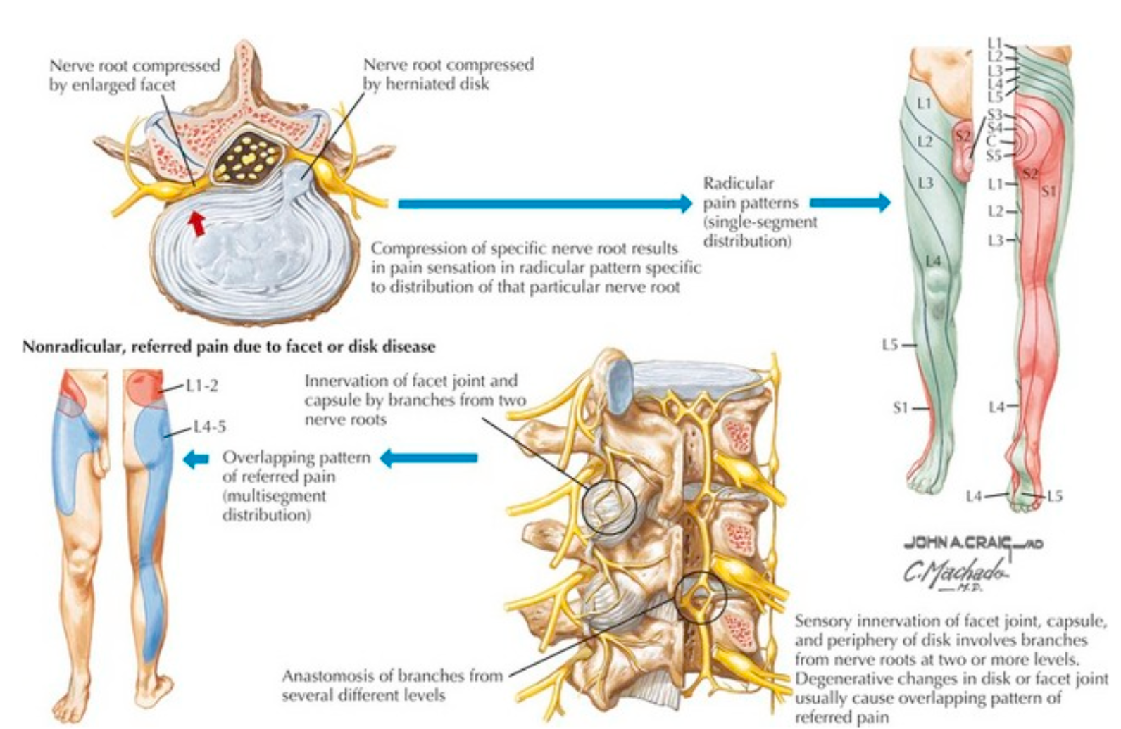 Nerve Root Distribution What Does My MRI Mean? Solutions Sports And
