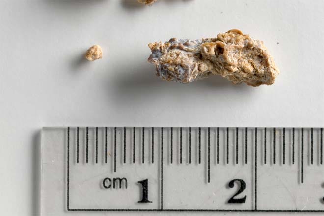 Natural ways to dissolve kidney stones – Taylor all know – Medium