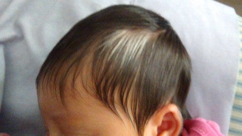 Everything You Need To Know About Your Baby’s Birthmarks & Their Types