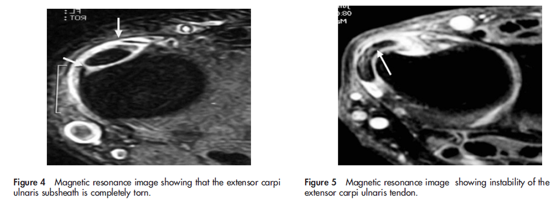 Ecu Tendon Zone