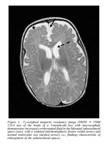 Benign enlargement of the subarachnoid spaces (BESS)