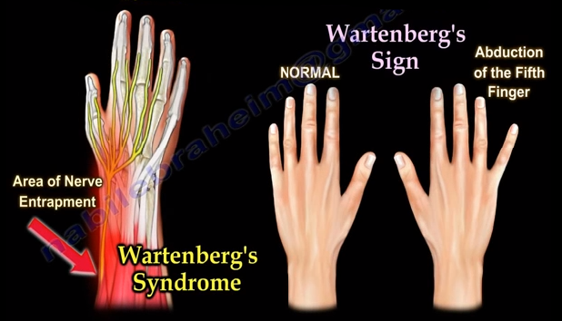 Wartenberg’s Syndrome – Nabil Ebraheim – Medium