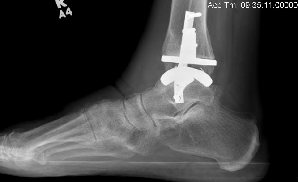 Use of Negative Pressure Wound Therapy on Closed Surgical Incision ...