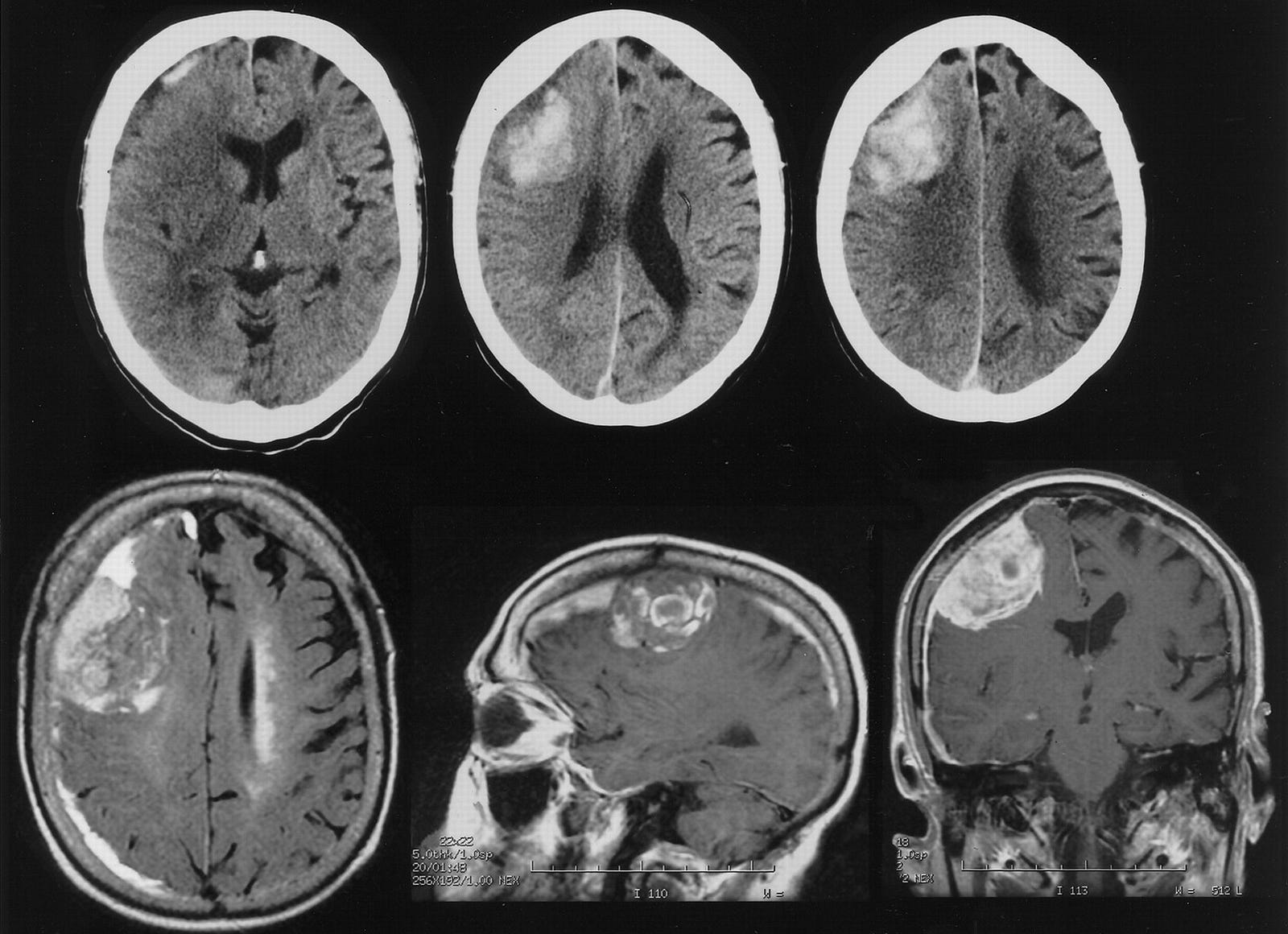 Detecting Brain Hemorrhage In Computed Tomography CT Imaging