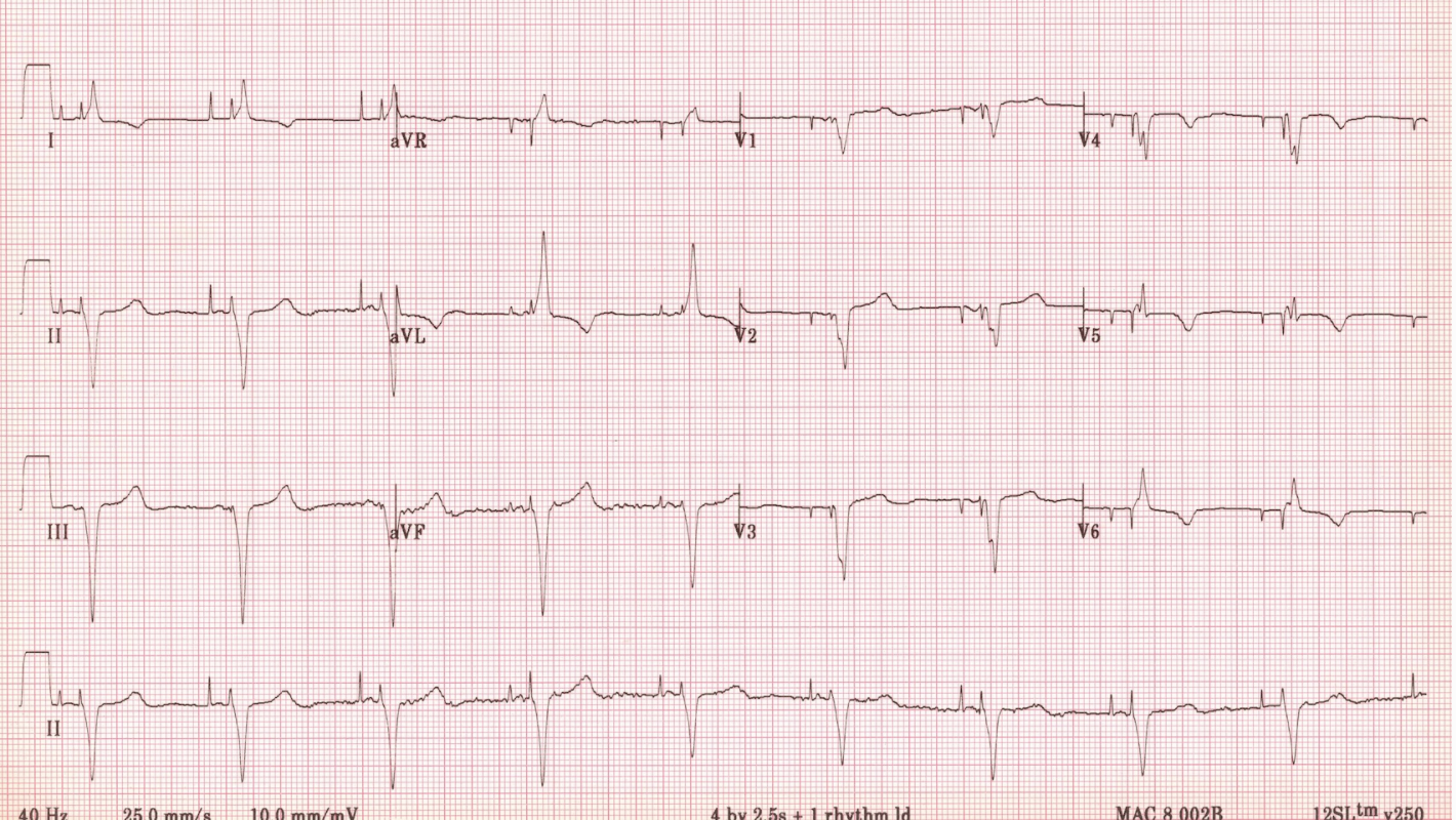 Pacemaker 101 – Tiffany Trinh – Medium