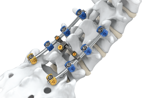 Arsenal’s Innovative Spinal Fixation System for Surgery