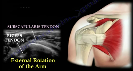 Subscapularis Tendon Rupture – Nabil Ebraheim – Medium