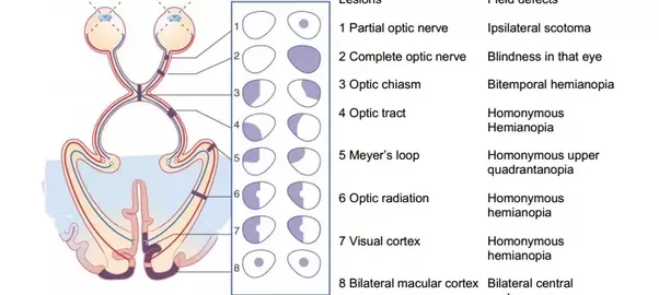 How do people with visual pathway deficits see the world?