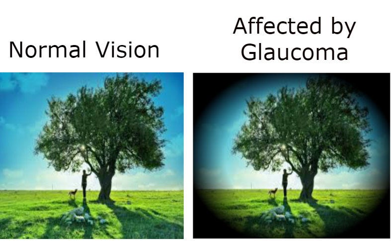 Glaucoma Who is at Risk? – ihealthkonnect – Medium
