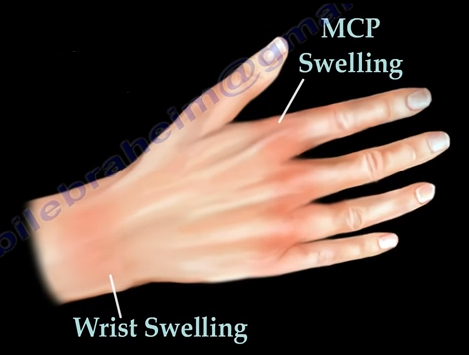 Rheumatoid Arthritis of the Hand – Nabil Ebraheim – Medium