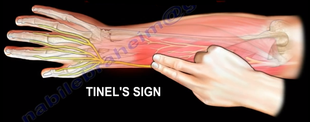 Wartenberg’s Syndrome – Nabil Ebraheim – Medium