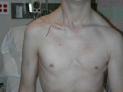 Brachial Plexus Injury – BeatBlueWhaleChallenge – Medium