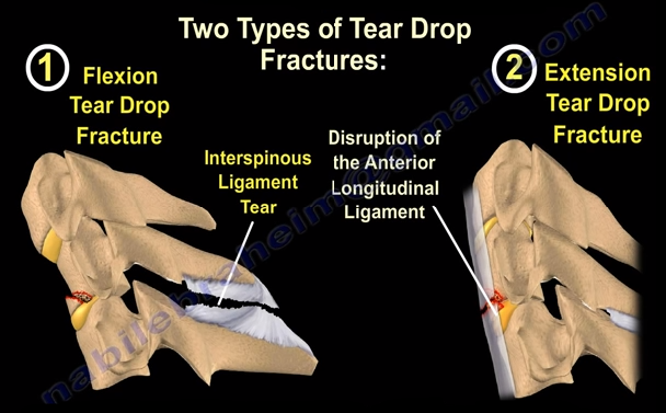 Tear Drop Fractures – Nabil Ebraheim – Medium