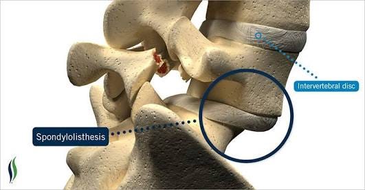 Lumbar Spine Stress Fractures — Spondyolysis – The Tennis Physio – Medium