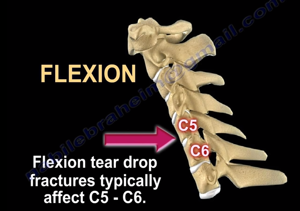 Tear Drop Fractures – Nabil Ebraheim – Medium