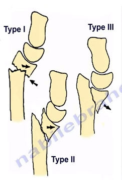 Common Types of Distal Radius Fractures – Nabil Ebraheim – Medium