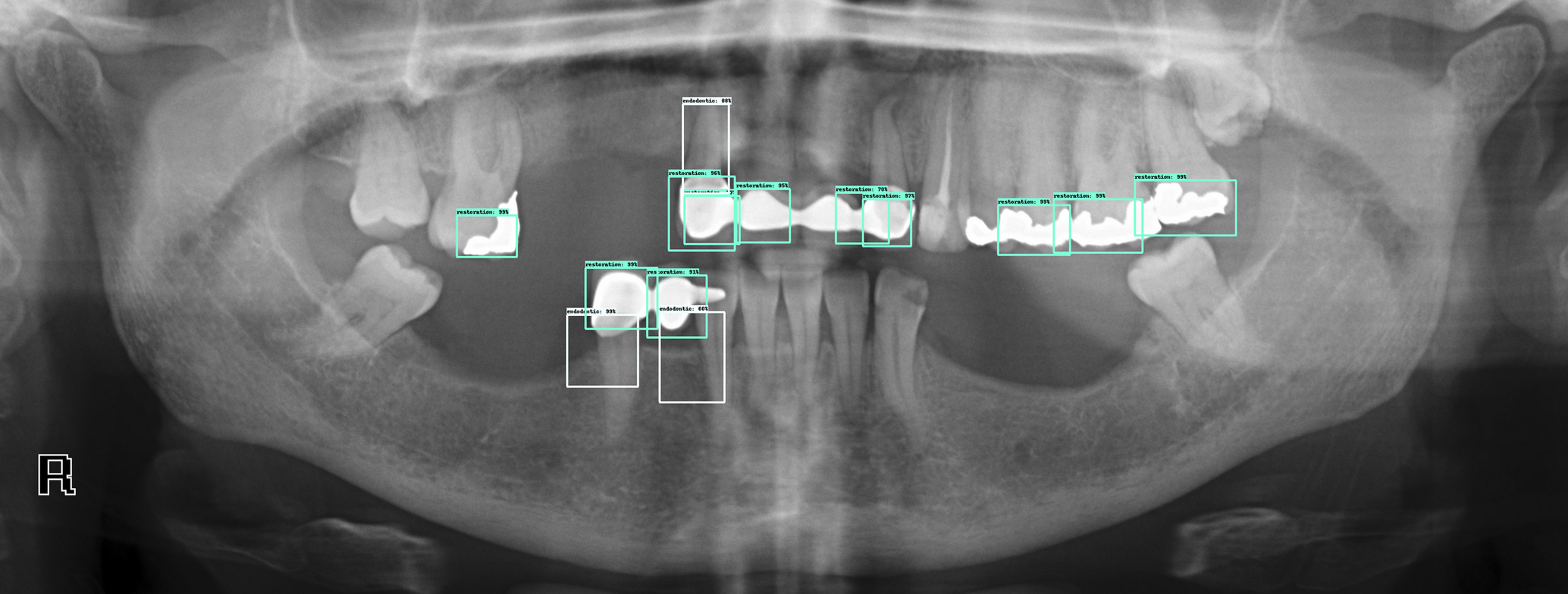 Deep Learning Object Detection On Dental X Rays Clement