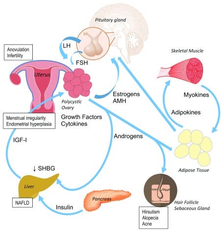 A complete guide to Polycystic ovarian syndrome (PCOS)