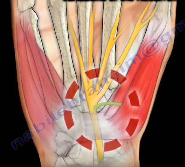 Ganglion Cyst Pressure Motor Branch of the Median Nerve