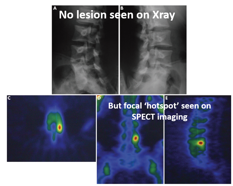 Lumbar Spine Stress Fractures — Spondylolysis